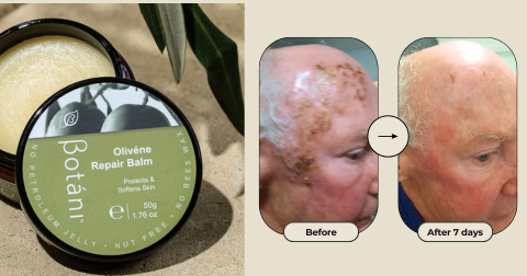 Chemo Rash Cream: Before and After Pictures
